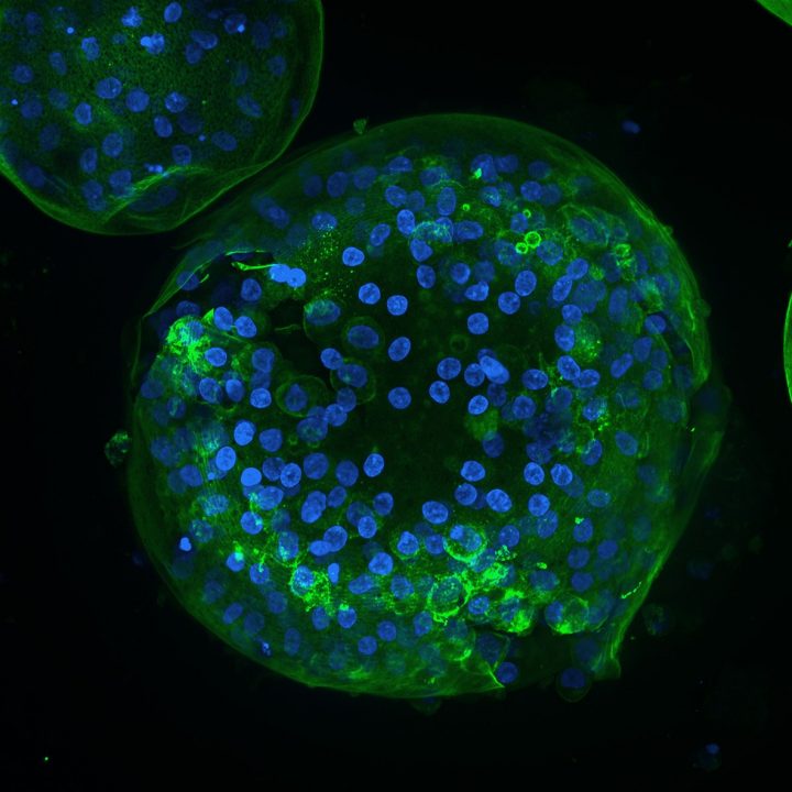 3D Cell Culture Solutions: Emerging Trends in Cancer Therapy